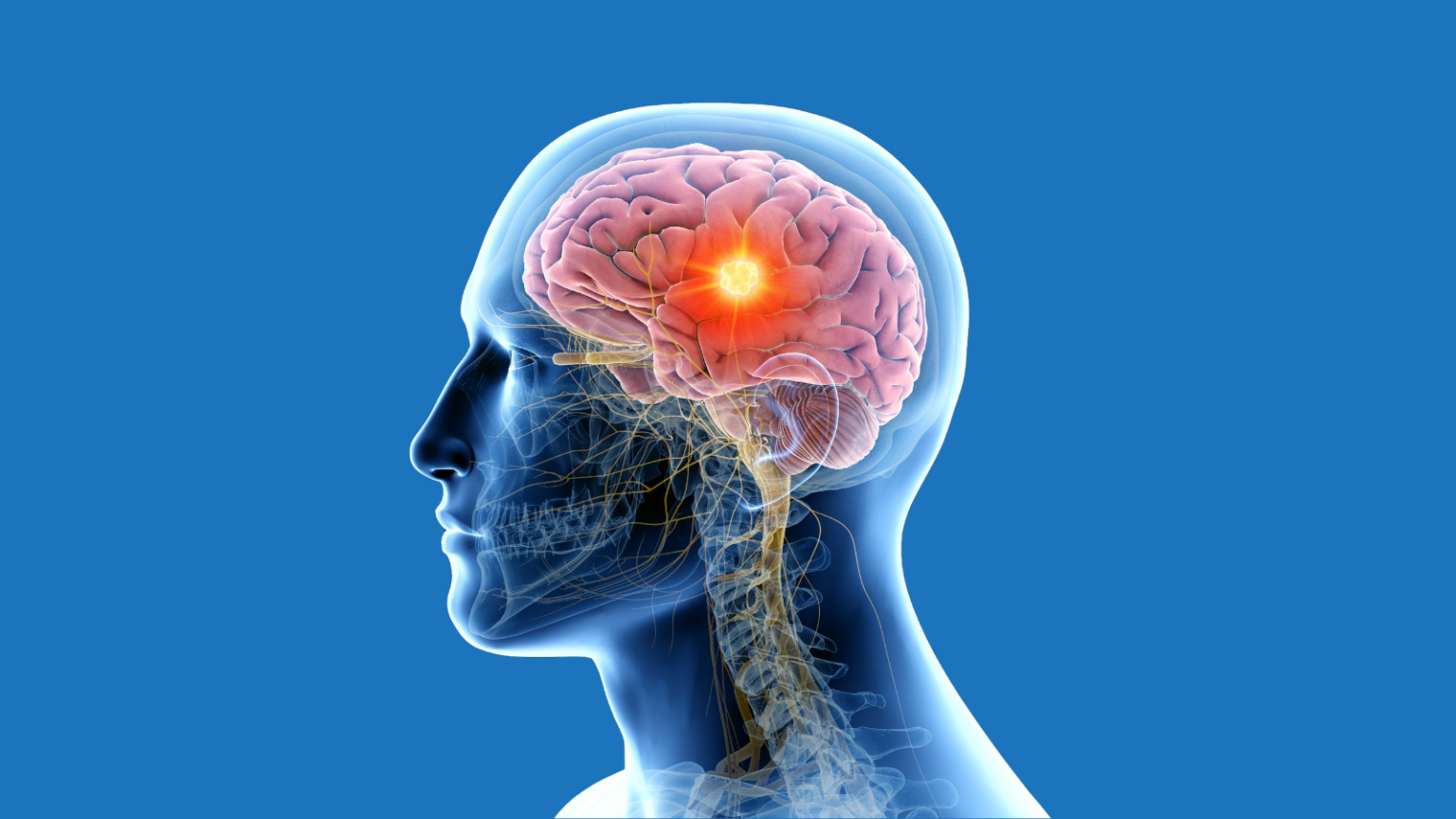 Understanding Schwannoma and Its Impact on Nerves