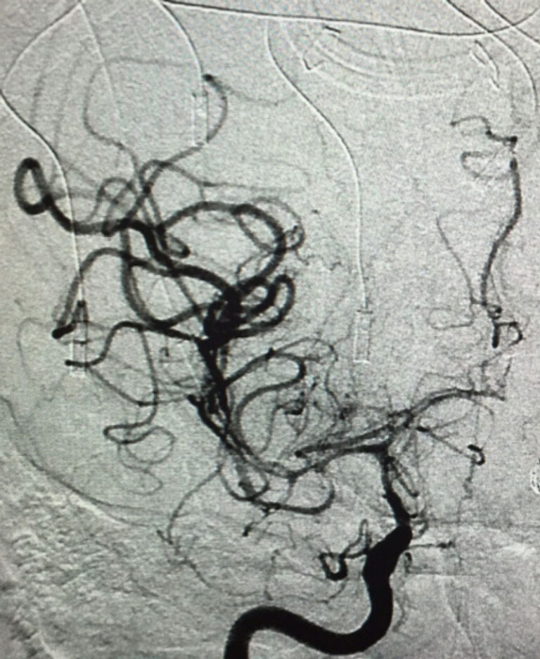 Vasospasm: What is it? Causes, Prevention, Treatment