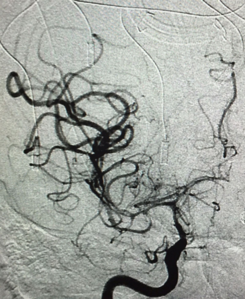 Vasospasm: What is it? Causes, Prevention, Treatment