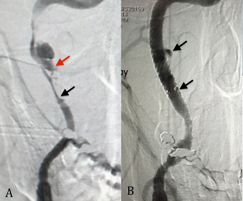 Vascular Dissection: Causes, Symptoms, and Treatments in NJ