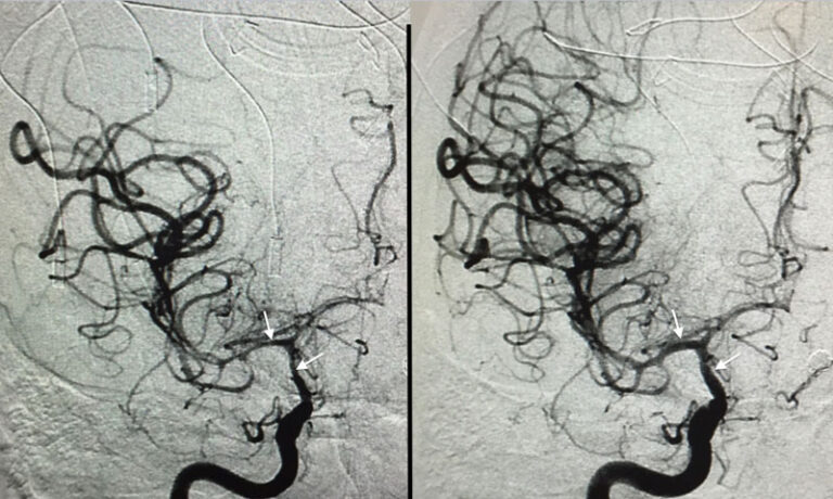 Vasospasm: What is it? Causes, Prevention, Treatment