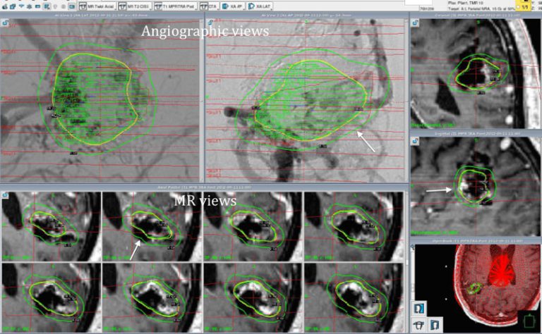 Cranial Stereotactic Radiosurgery: Procedure, Recovery & Benefit