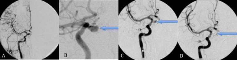 Brain Aneurysm Coiling Treatment - Endovascular Procedure