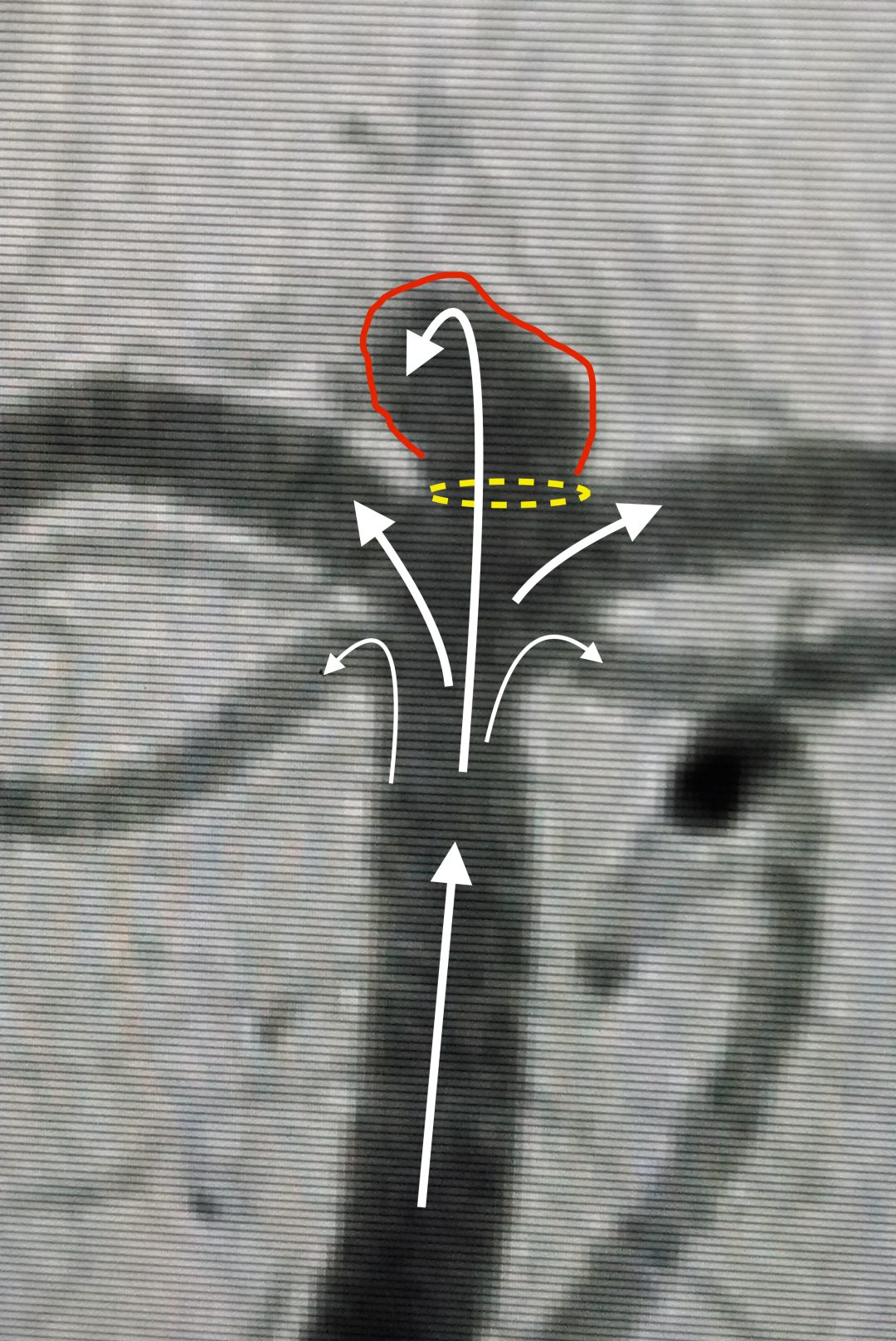 Aneurysm Coiling - Effectively Treating a Ruptured Aneurysm