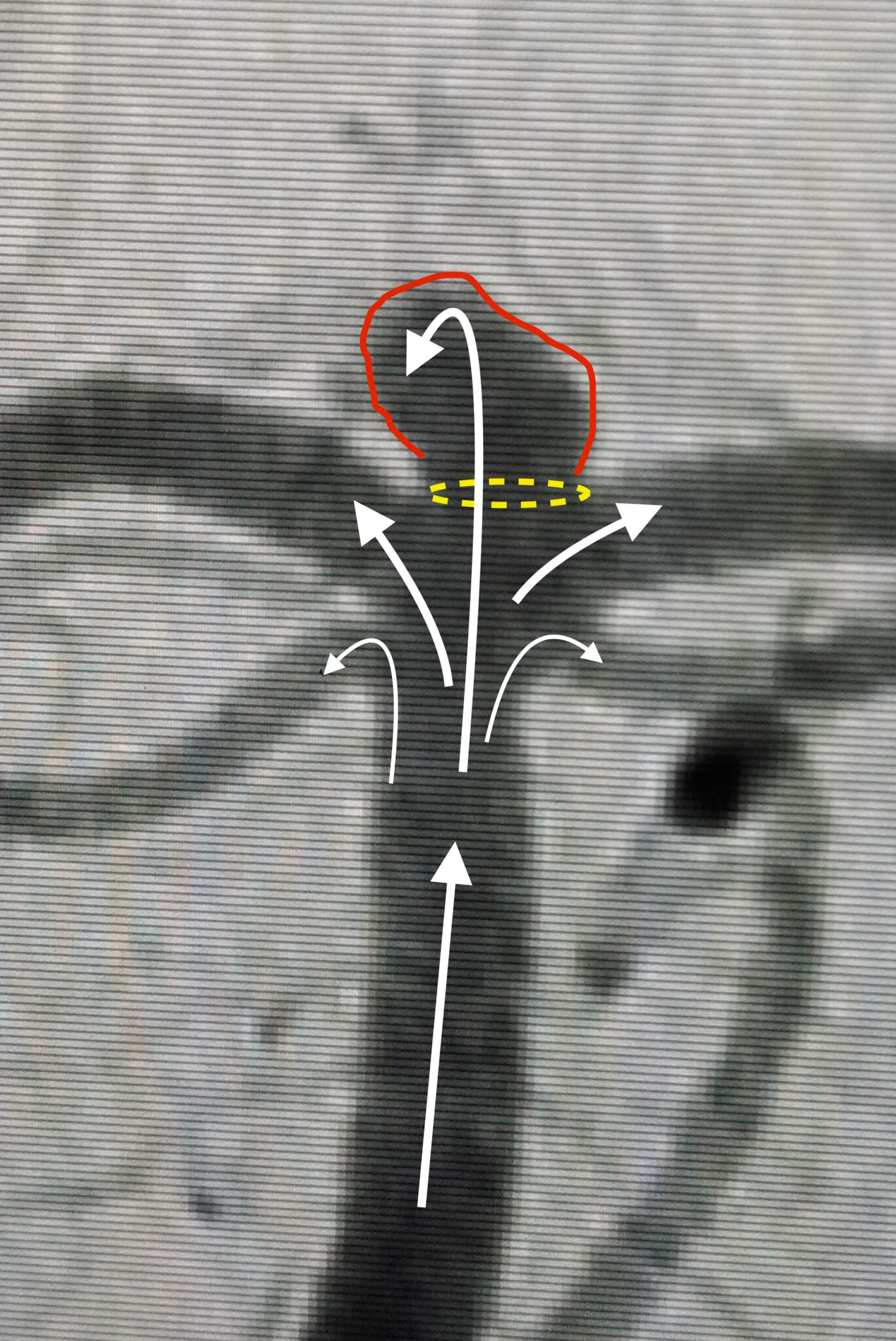 Aneurysm Coiling - Effectively Treating a Ruptured Aneurysm