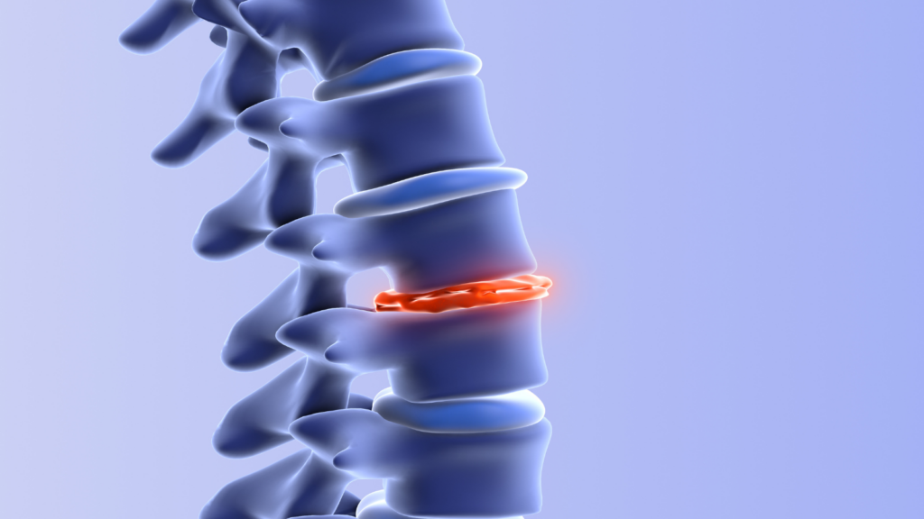 Restore Stability With Spinal Fusion for Degenerative Disc Disease