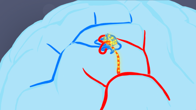 Brain Aneurysm Coiling Recovery - What to Expect and Timelines