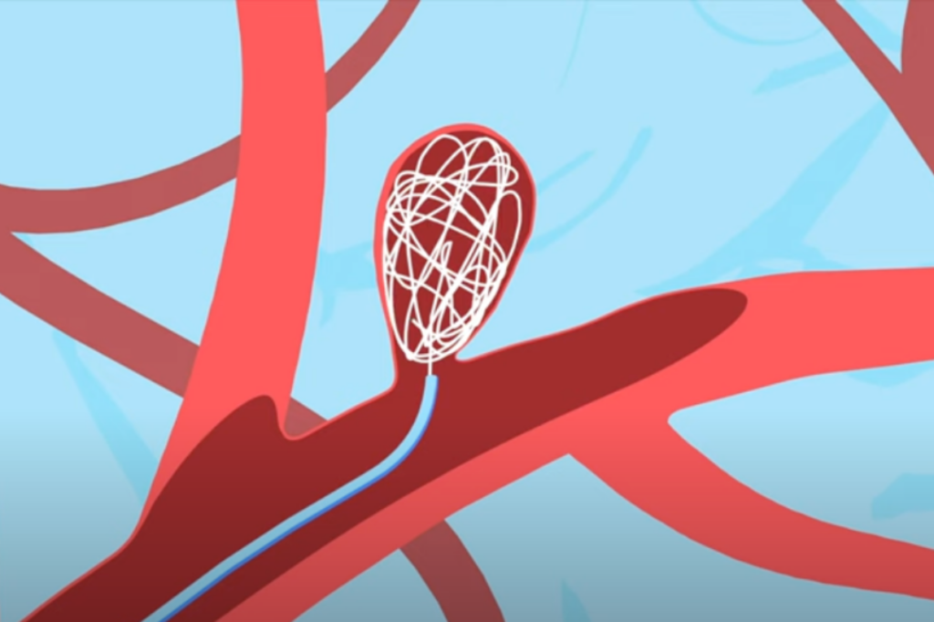 Aneurysm Coiling - Effectively Treating a Ruptured Aneurysm