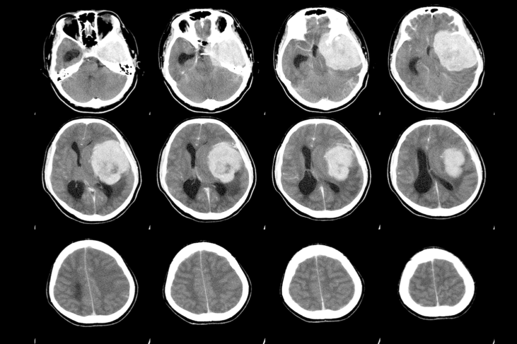 Meningioma Tumor: Understanding the Condition and Treatments