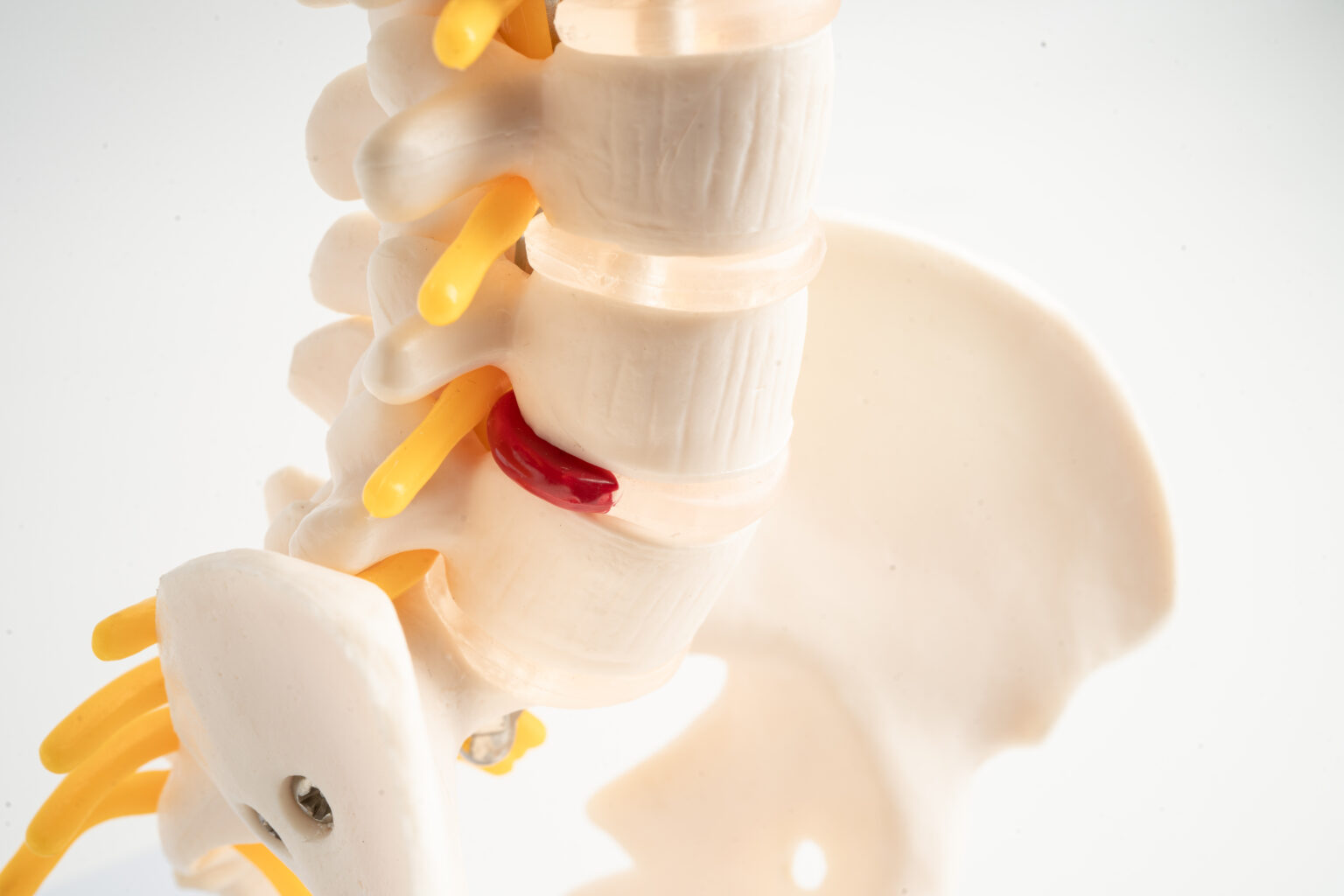 Know the Symptoms: Cervical Spinal Stenosis or a Pinched Nerve?