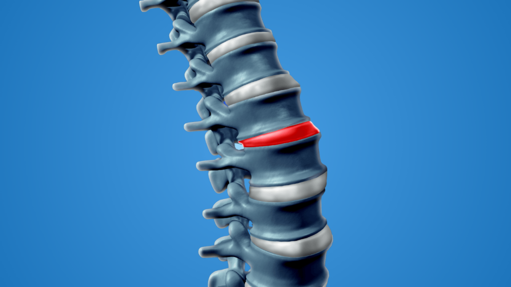 Herniated Disc Surgery & Recovery Time: What to Expect