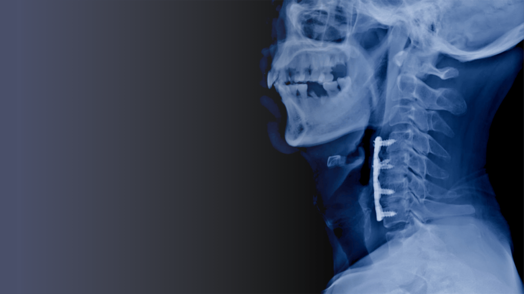 Lumbar Spinal Stenosis vs Cervical Spinal Stenosis | NJ Brain & Spine ...