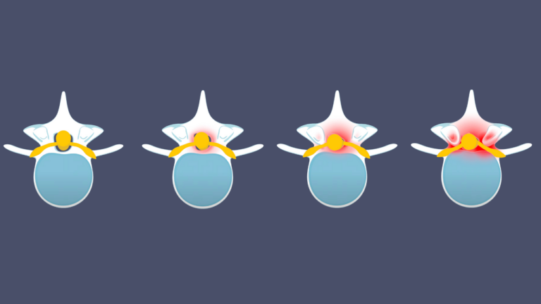 Herniated Disc Surgery & Recovery Time: What to Expect