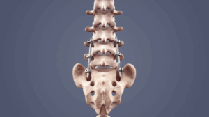 Posterior Lumbar Interbody Fusion (PLIF) - New Jersey Brain and Spine